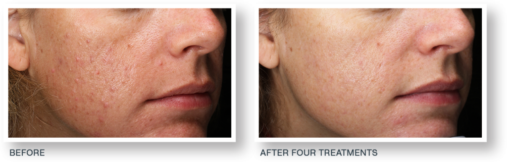 Microneedling | Randali Centre for Aesthetic Medicine